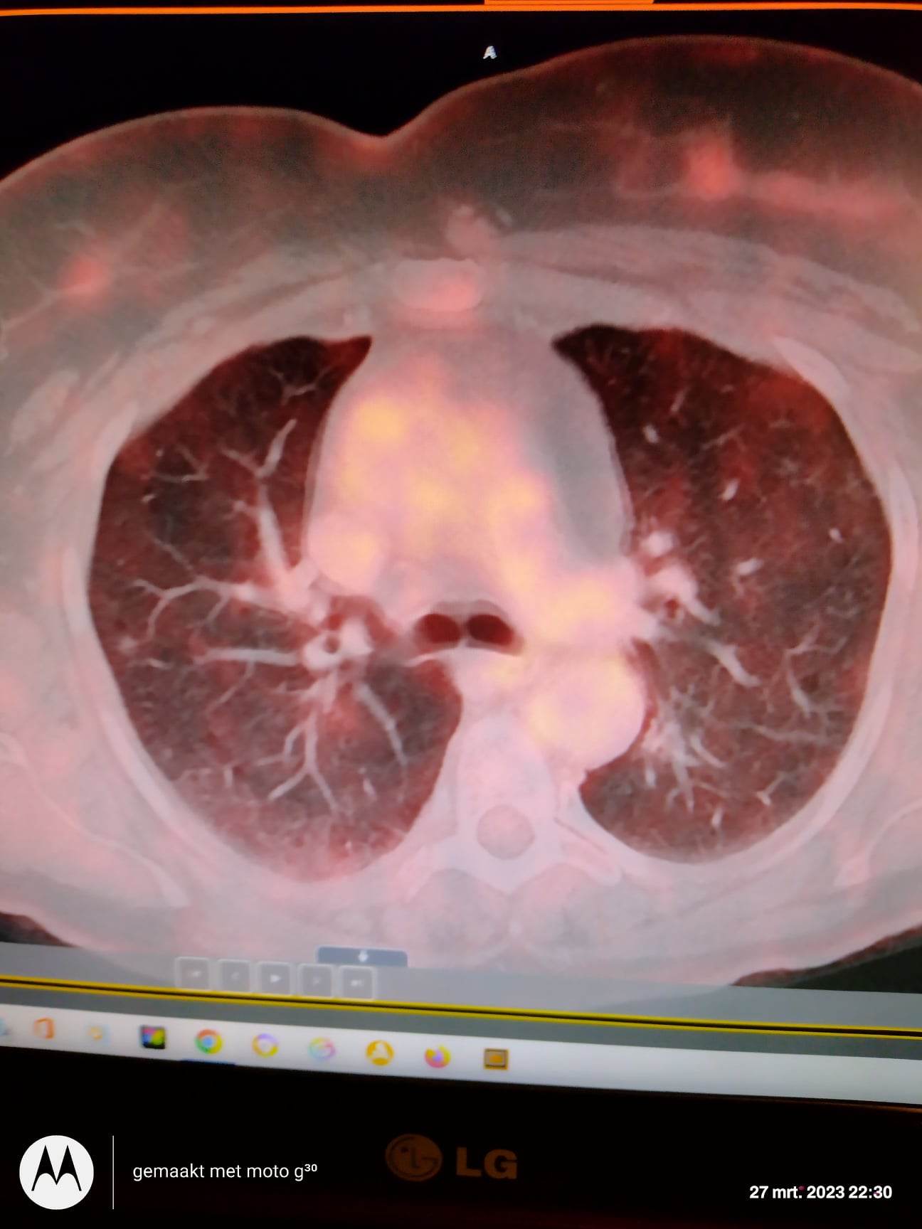 Verschillende longletsels te zien op pet-scan - Beantwoord - | Longforum